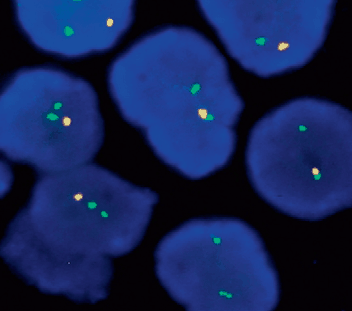 Nuevo juego de sondas FISH para el diagnóstico de gliomas Clinisciences